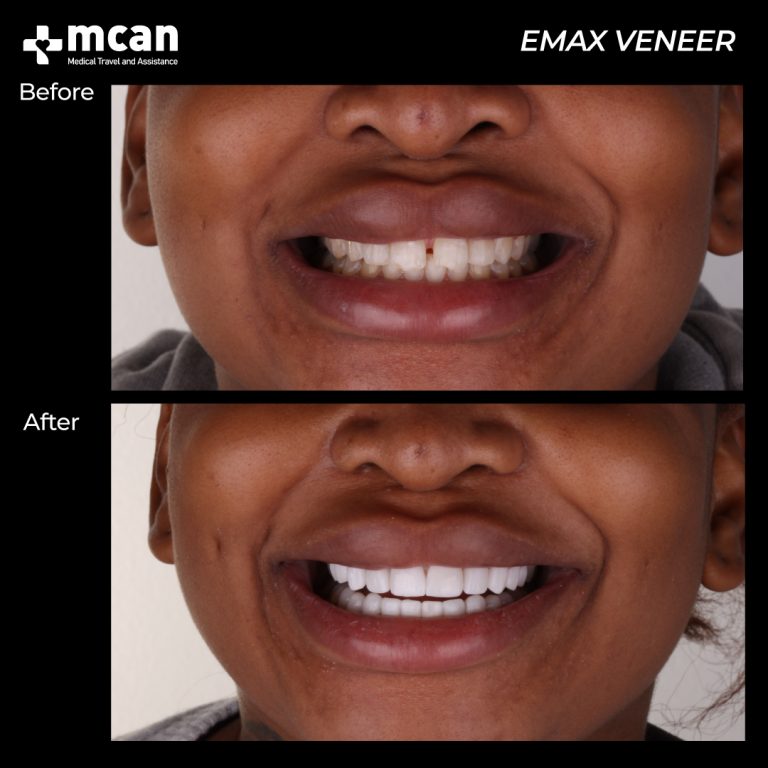 What Should I Know About Emax Veneers? - MCAN Dental