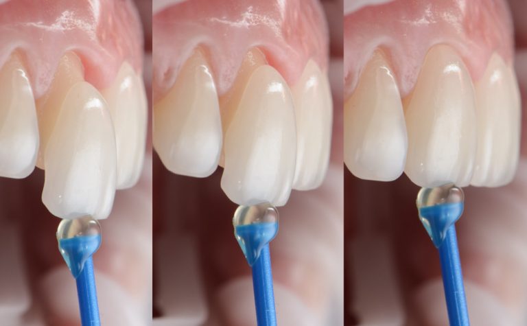 What Should I Know About Emax Veneers? - MCAN Dental