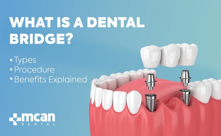 What Is a Dental Bridge? Types, Procedure, and Benefits Explained ...
