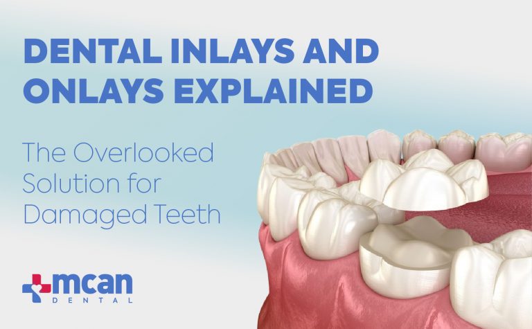Dental Inlays and Onlays Explained: The Overlooked Solution for Damaged ...
